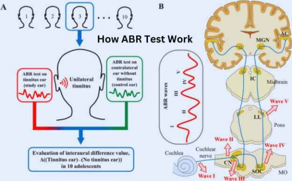 Auditory Brainstem Response (ABR) Test Cost & Details in Pakistan